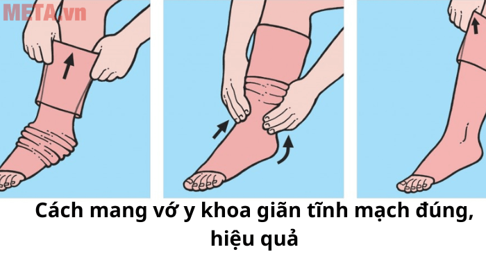 Cách mang vớ y khoa giãn tĩnh mạch đúng, hiệu quả - META.vn